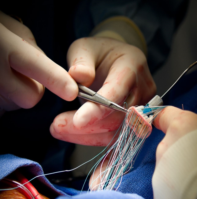 The TAVI Learning Curve: The Clinical Imperative for Simulation-Based Training | Mentice News Blog